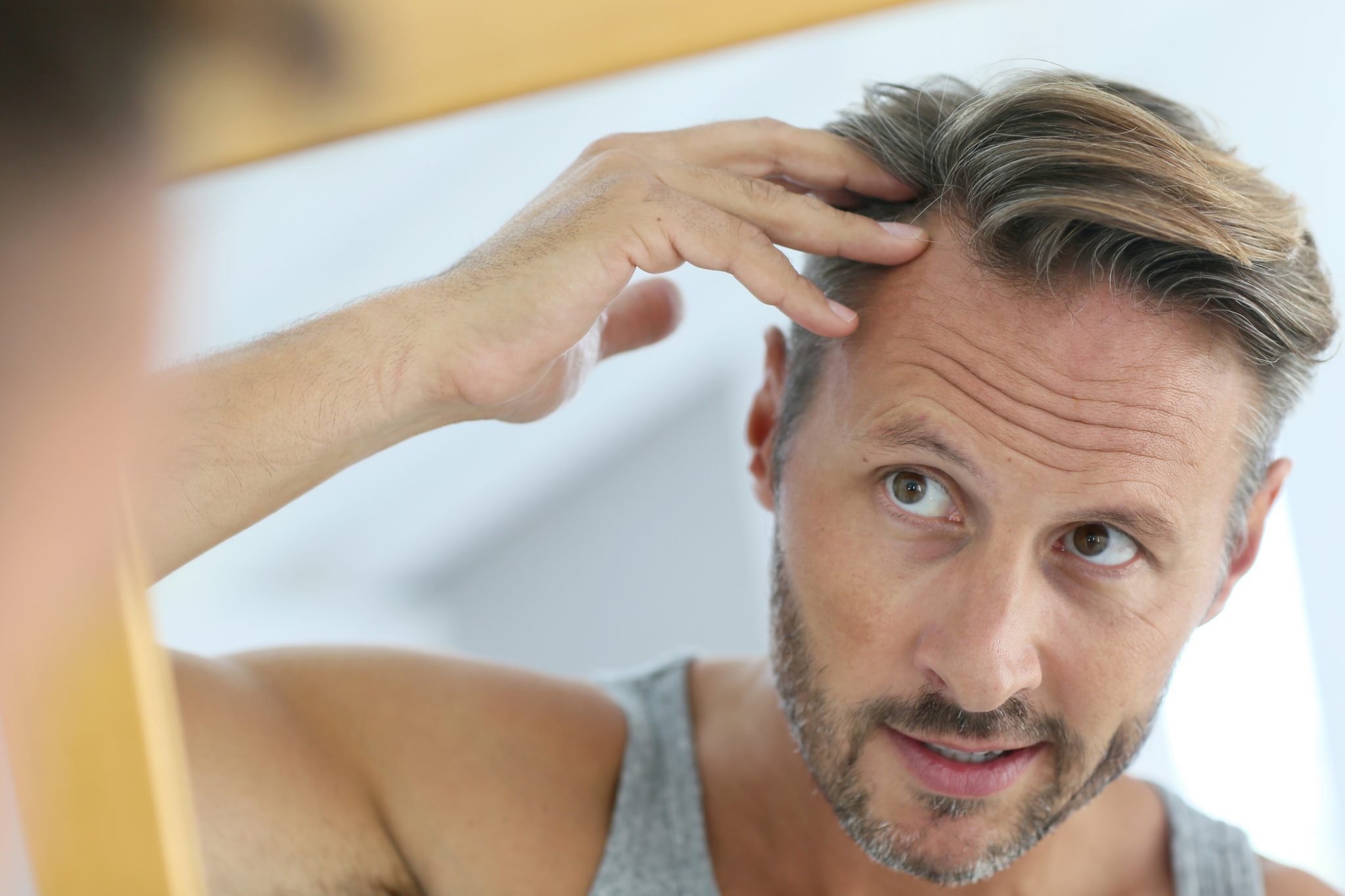 Tipos de calvicie: cómo reconocer las 7 clases de alopecia masculina