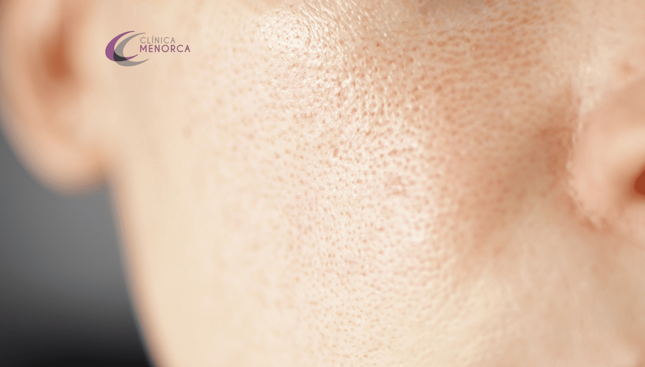 ¿Poros abiertos en la cara? Descubre como solucionarlo