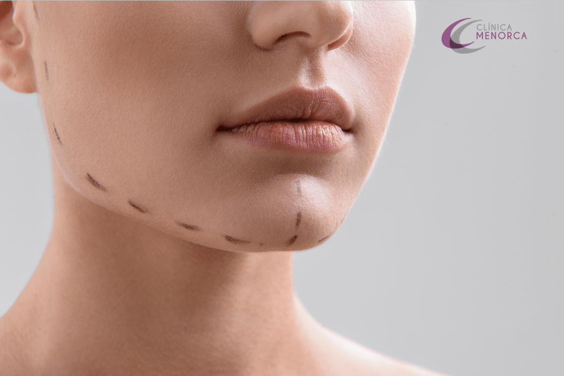 ¿Problemas con el mentón? Descubre los tipos de mentoplastia
