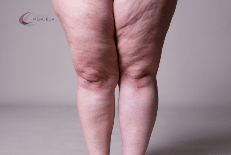 Lipedema en las piernas: síntomas, fases y tratamientos
